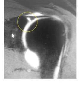 Lesiones Slap – Dr Álvaro Botía