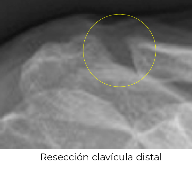 Artrosis Acromioclavicular – Dr Álvaro Botía